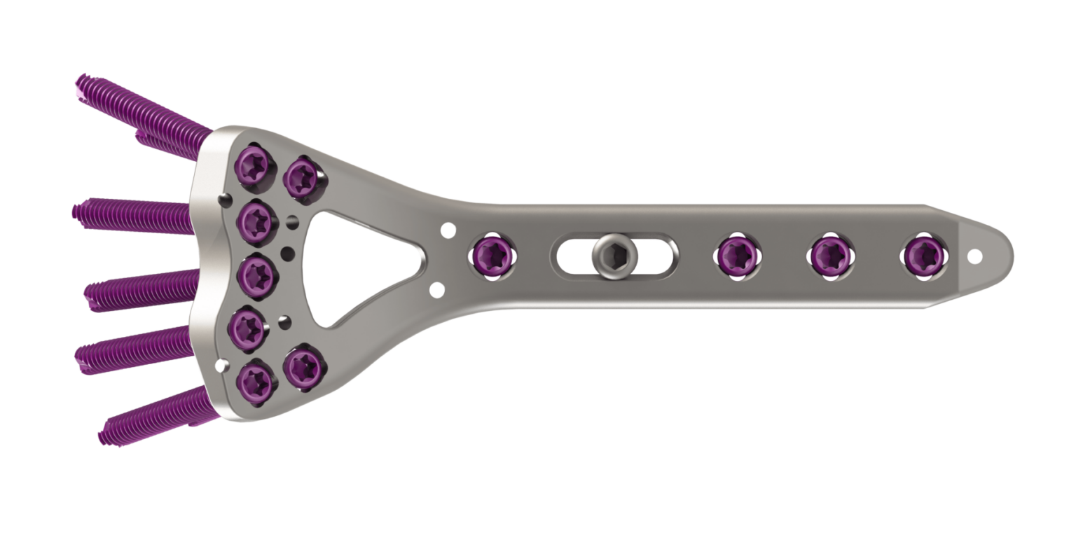 Distal Radius - SiS Medical GmbH